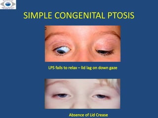 PTOSIS . CLINICAL FEATURES . DIAGNOSIS . MANAGMENT LINES | PPTX