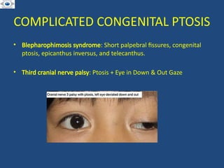 PTOSIS . CLINICAL FEATURES . DIAGNOSIS . MANAGMENT LINES | PPTX