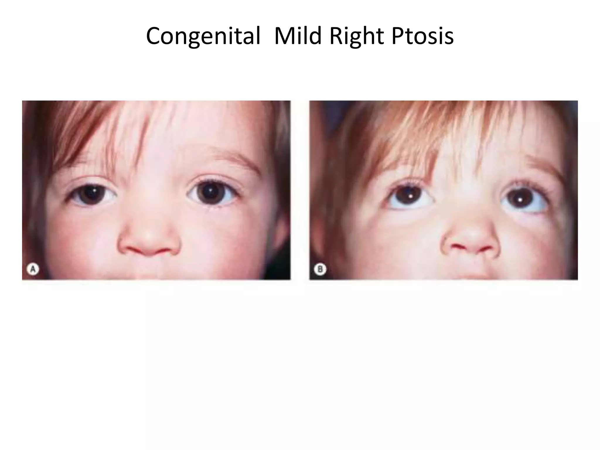 PTOSIS OF EYELIDS.pptx