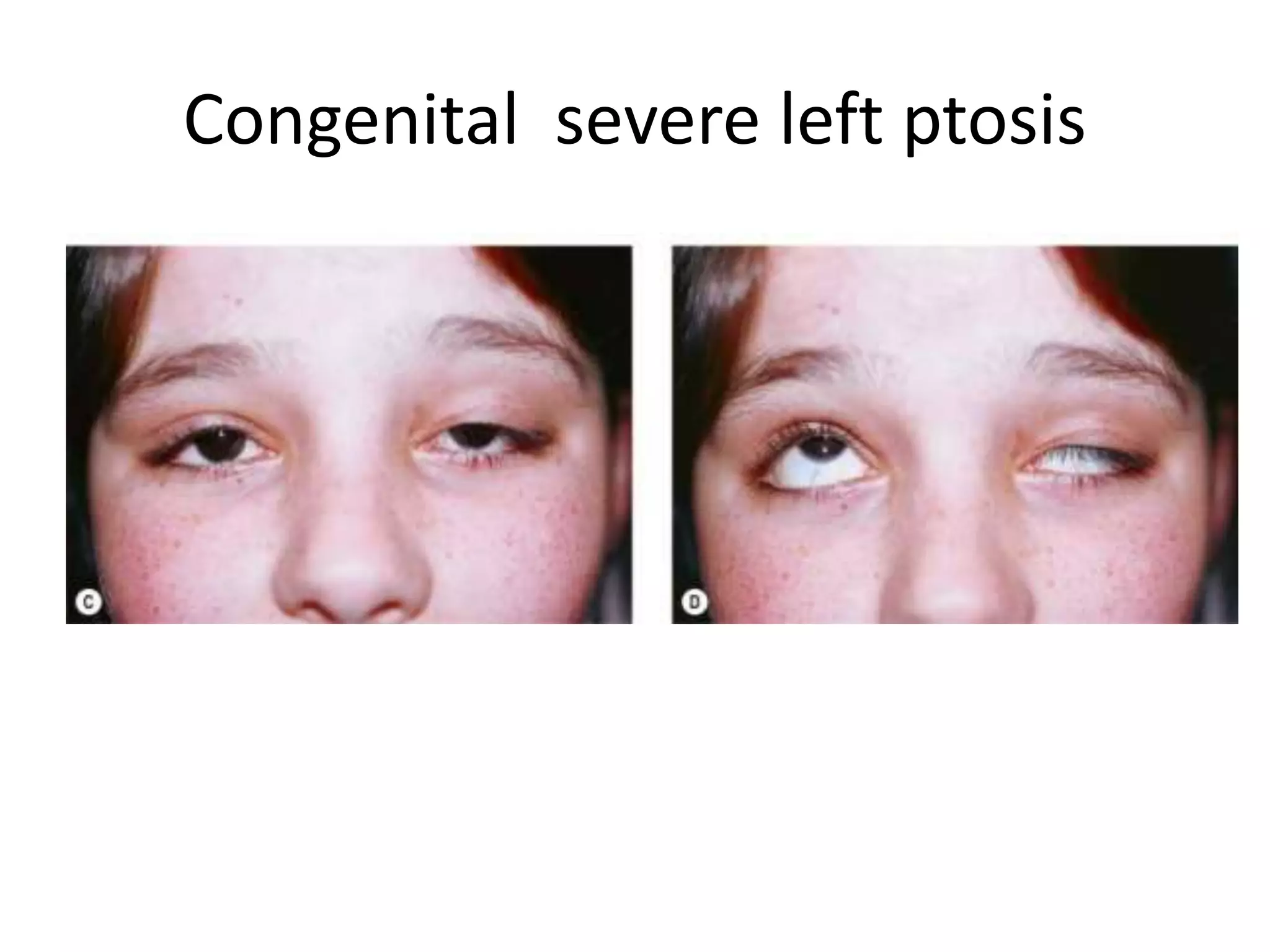 PTOSIS OF EYELIDS.pptx