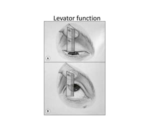 PTOSIS OF EYELIDS.pptx