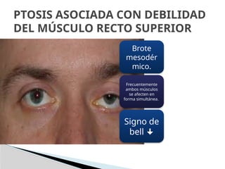 seminario de ptosis palpebral. Oftalmologia | PPTX