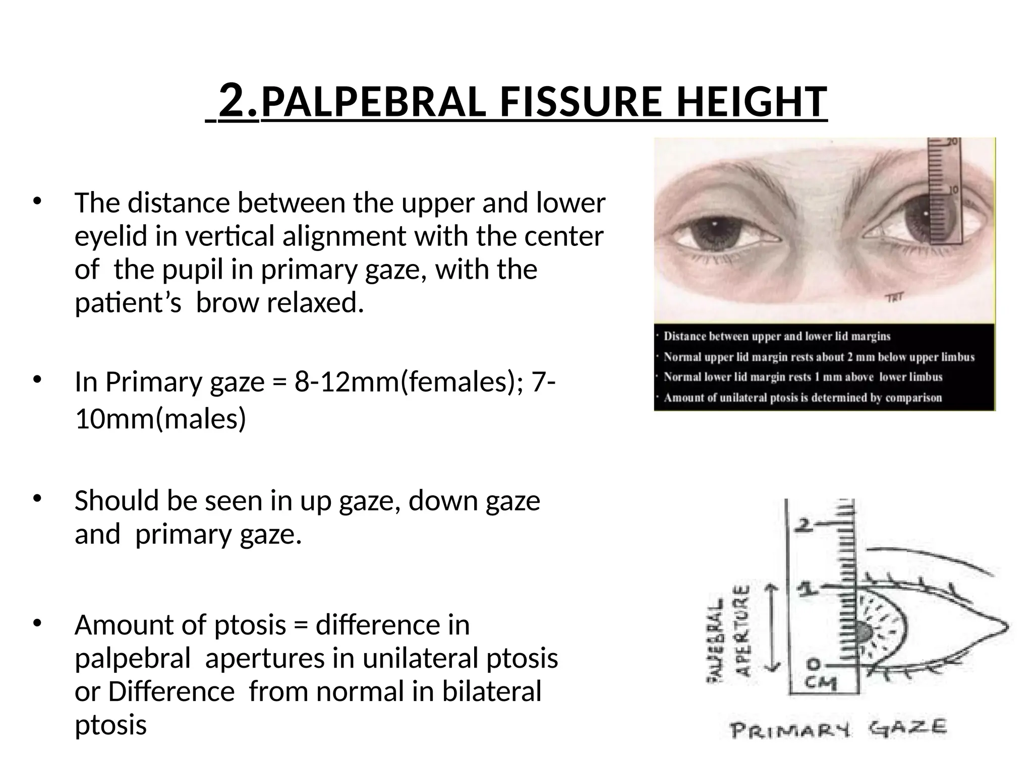 Case of ptosis and it’s diagnosis and management | PPT