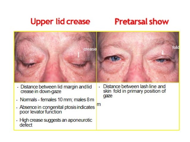 Case of ptosis and it’s diagnosis and management | PPT