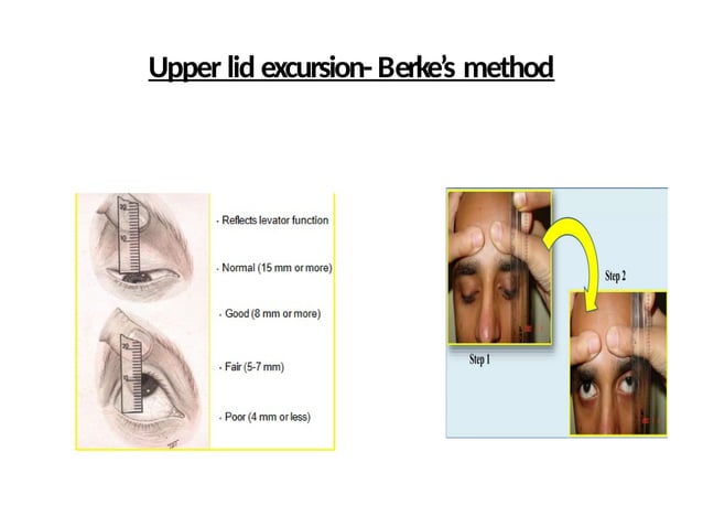 Case of ptosis and it’s diagnosis and management | PPT