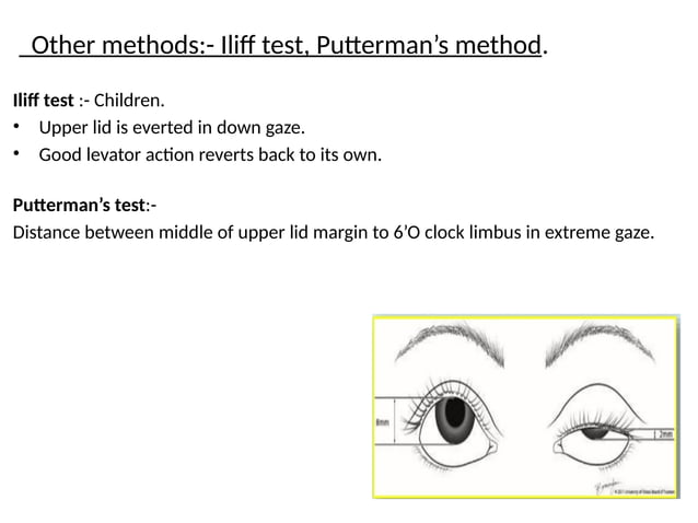 Case of ptosis and it’s diagnosis and management | PPT