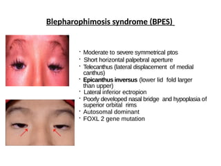 Case of ptosis and it’s diagnosis and management | PPTX