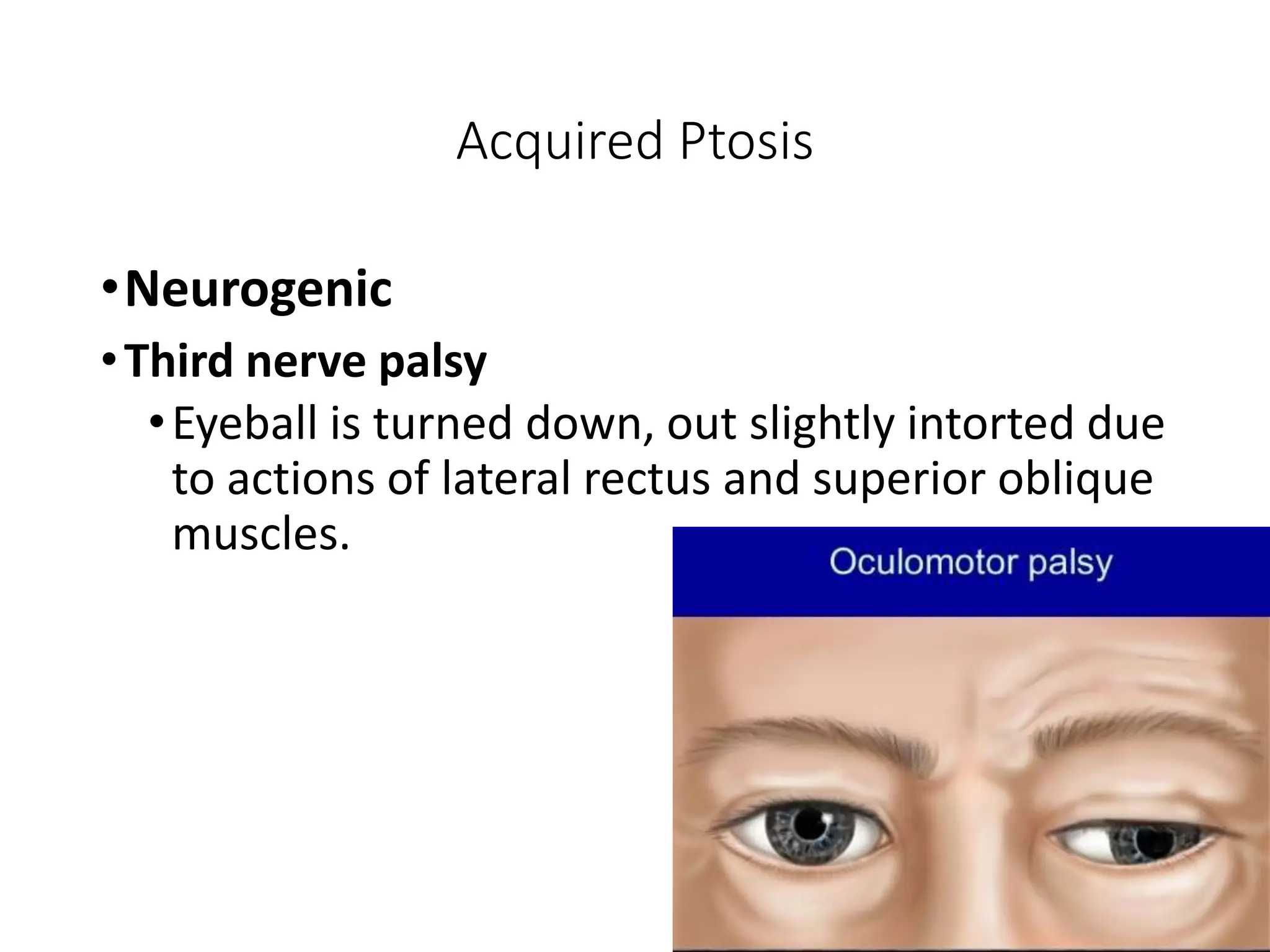Ptosis, Proptosis,and Watery Eye for undergraduatemedicine.pptx