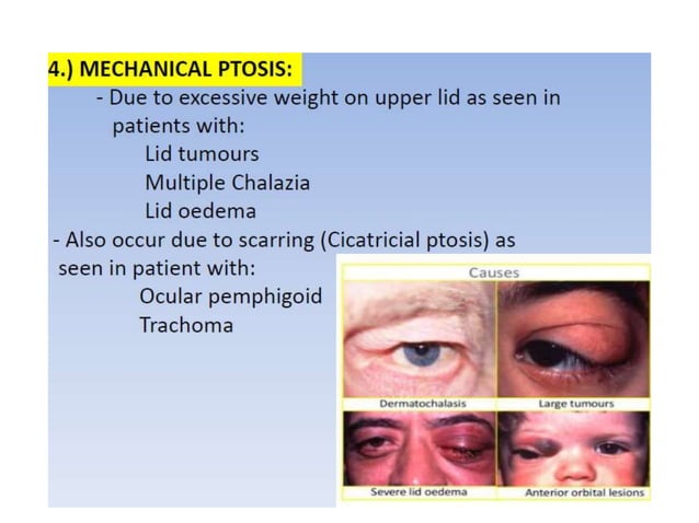 Ptosis, Proptosis,and Watery Eye for undergraduatemedicine.pptx | Free ...