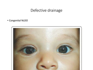 Ptosis, Proptosis,and Watery Eye for undergraduatemedicine.pptx