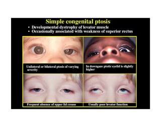 Ptosis, Proptosis,and Watery Eye for undergraduatemedicine.pptx