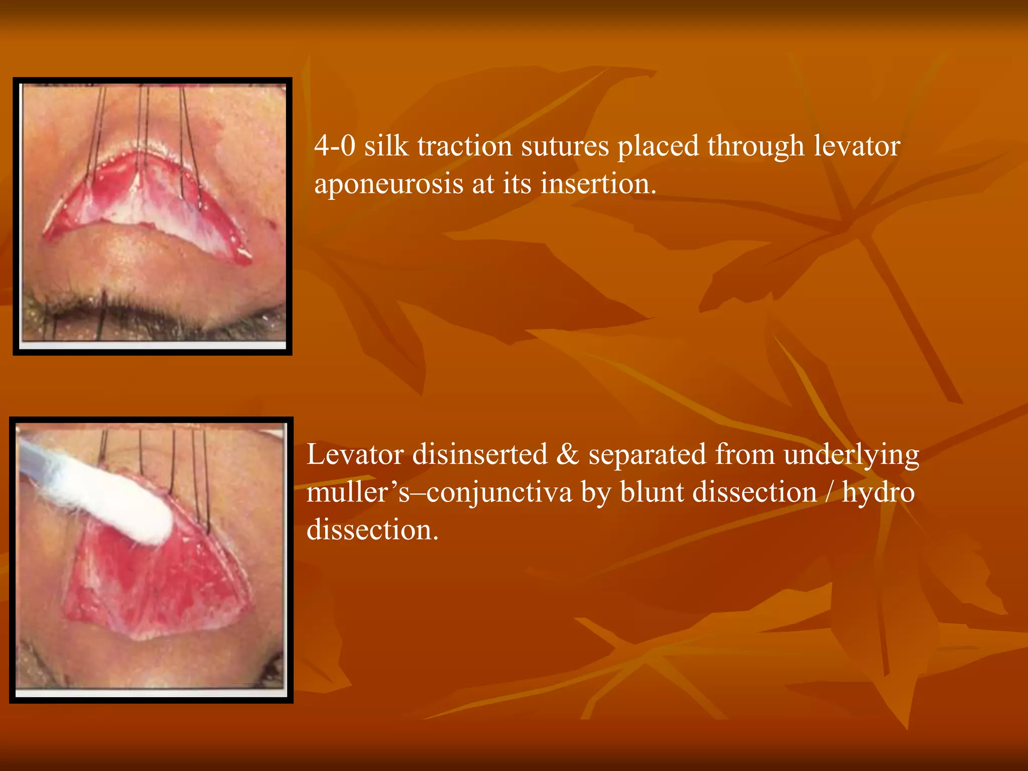 Ptosis surgery | PPTX