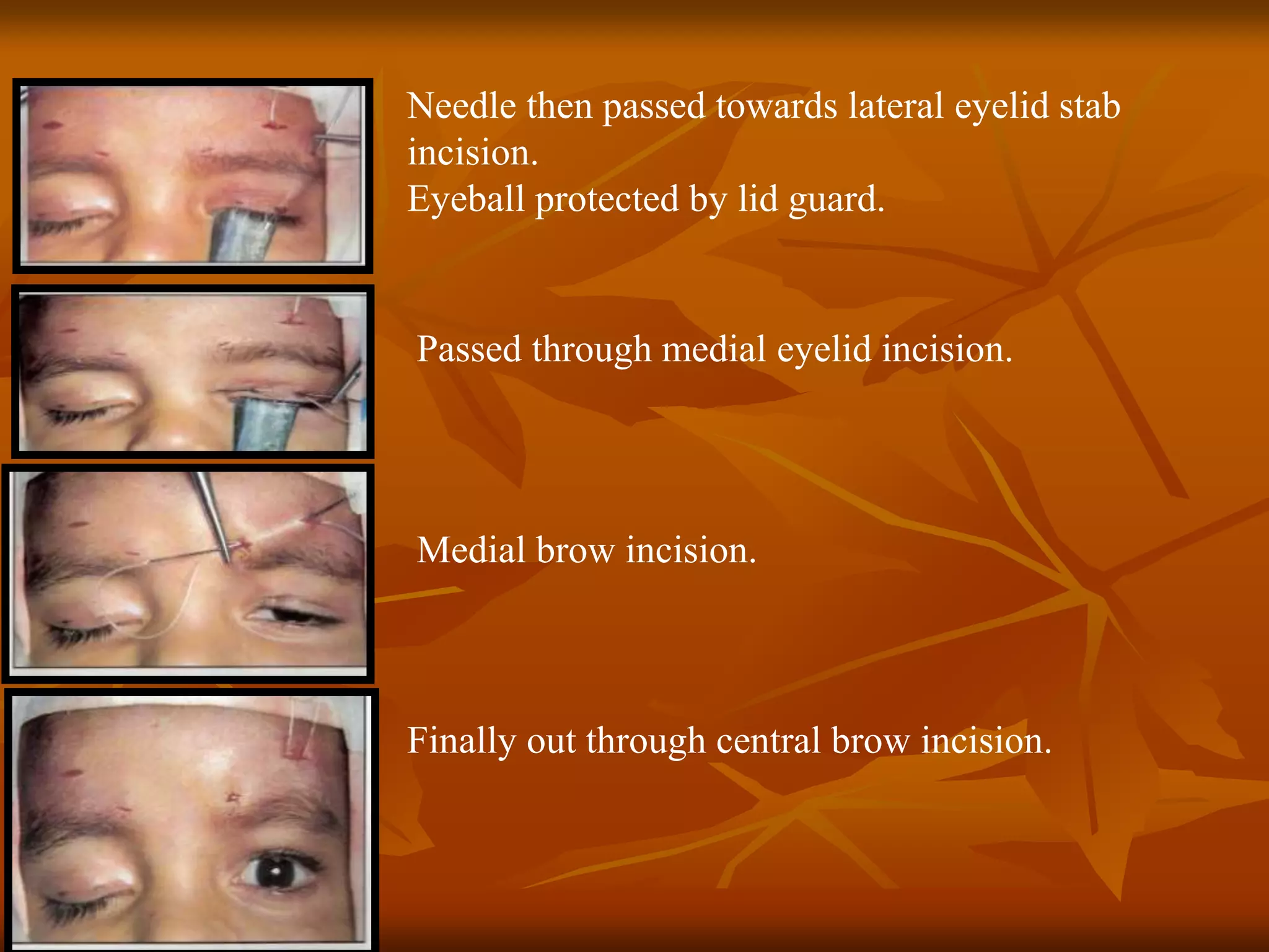 Ptosis surgery | PPTX