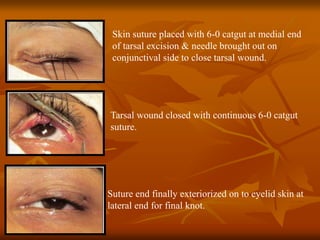 Ptosis surgery | PPTX