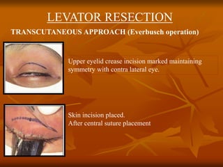 Ptosis surgery | PPTX