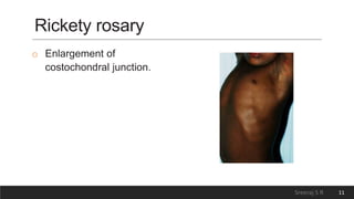 Physiotherapy for Rickets and Osteomalacia | PPTX
