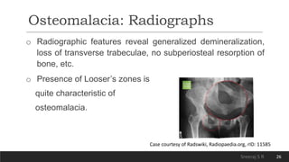 Physiotherapy for Rickets and Osteomalacia | PPTX