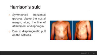 Physiotherapy for Rickets and Osteomalacia | PPT