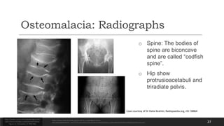 Triradiate Pelvis Osteomalacia