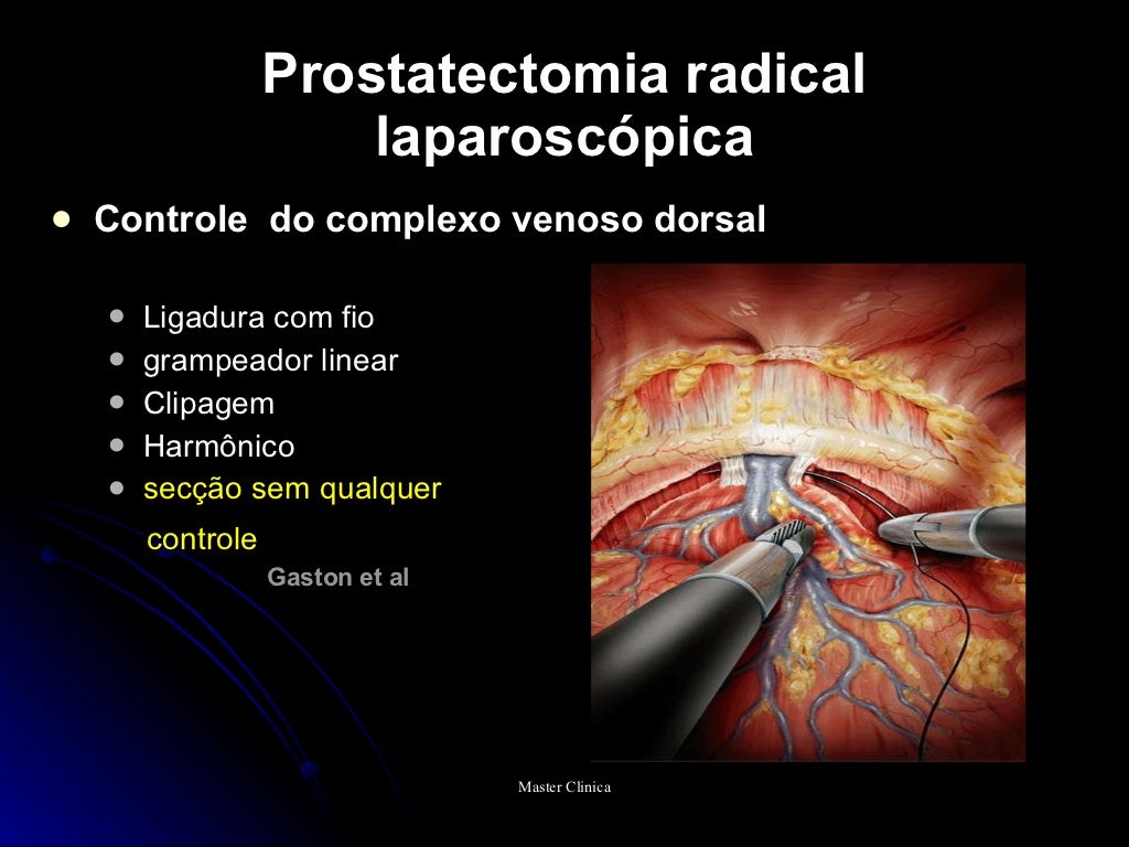 Prostatectomia radical laparoscópica - Jornada Paranaense