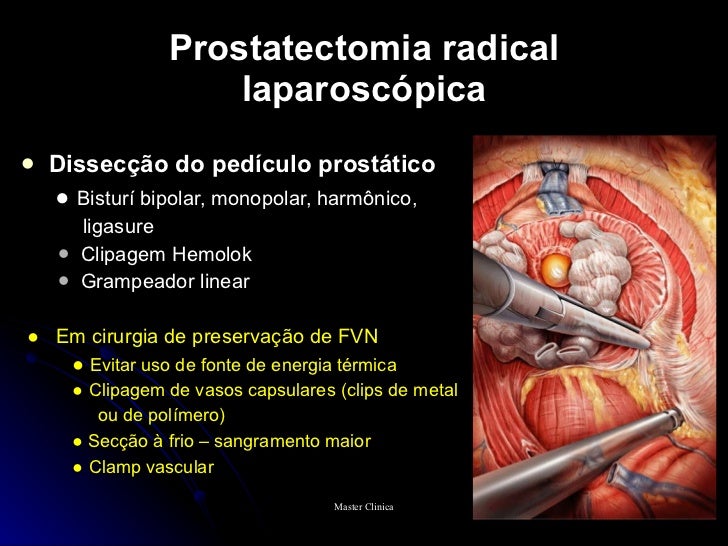 Prostatectomia radical laparoscópica - Jornada Paranaense