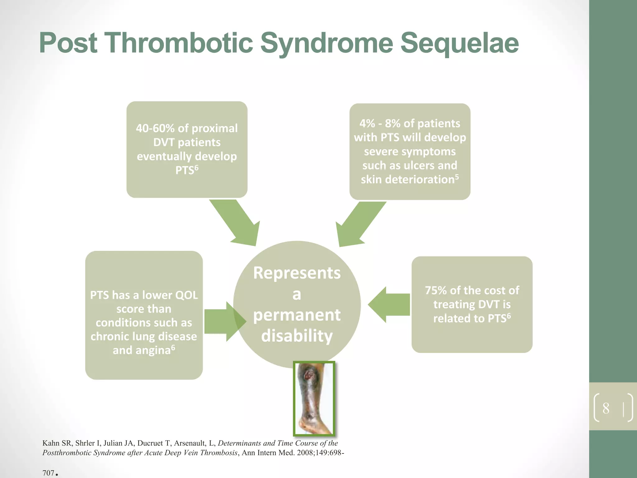 Iliofemoral DVT thrombolysis | PPTX