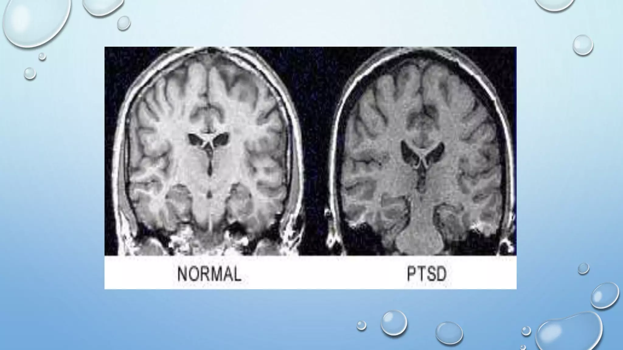 Ptsd | PPTX
