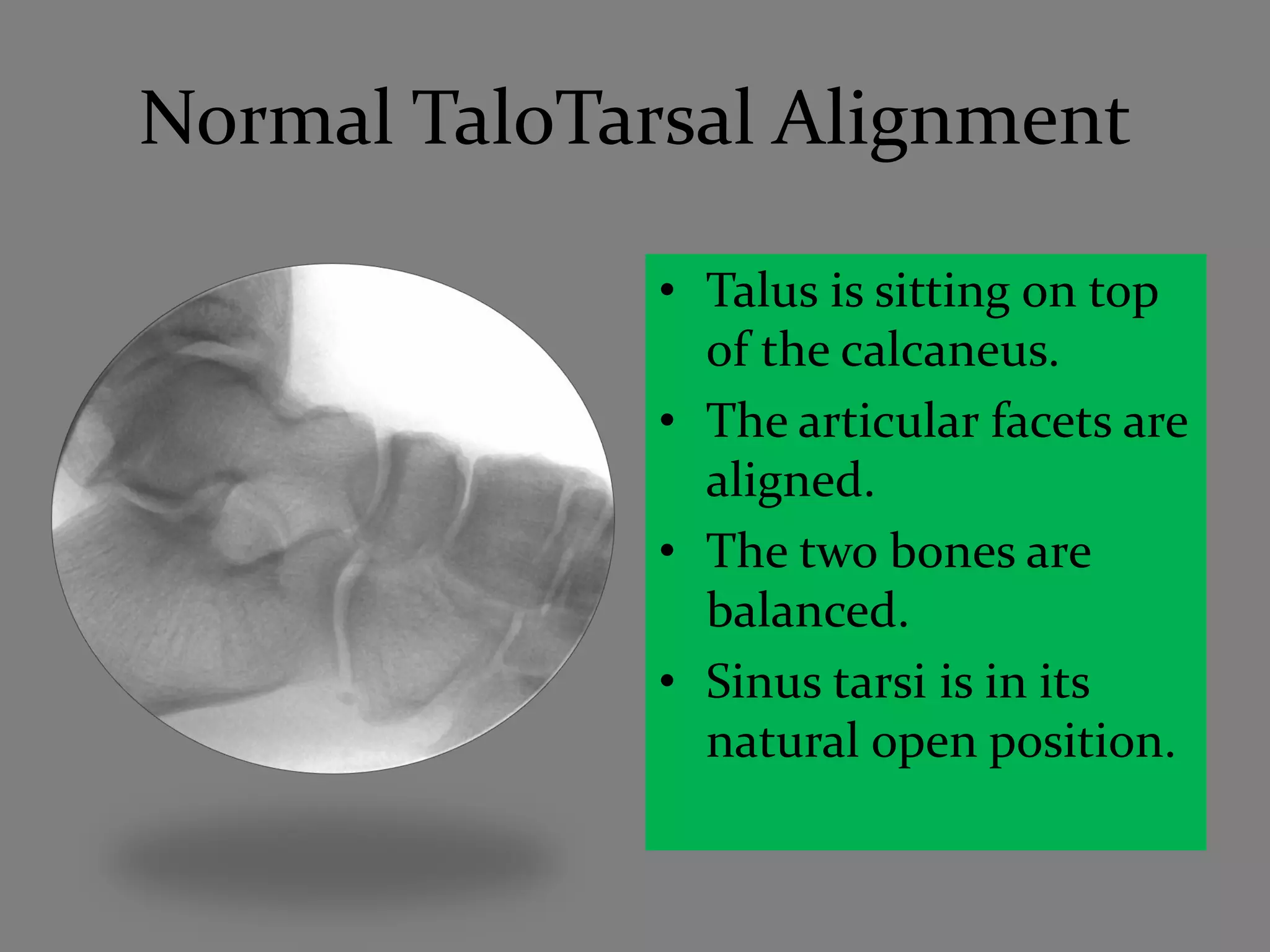 Posterior Tibial Tendon Dysfunction | PDF