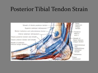 Posterior Tibial Tendon Diagram