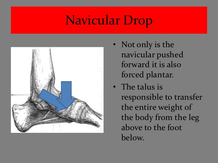 Posterior Tibial Tendon Dysfunction