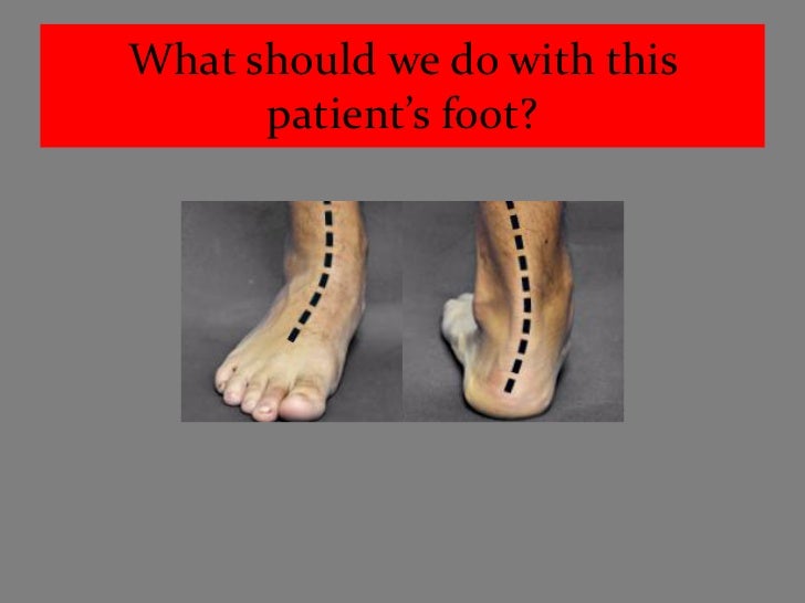 Posterior Tibial Tendon Dysfunction