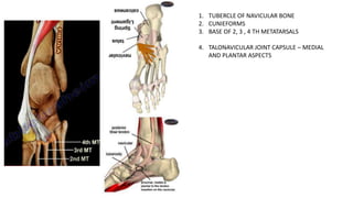 PTTD - Acquired Pes Planus | PDF