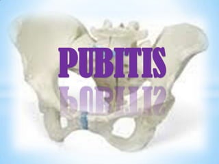 Pubitis | PPTX