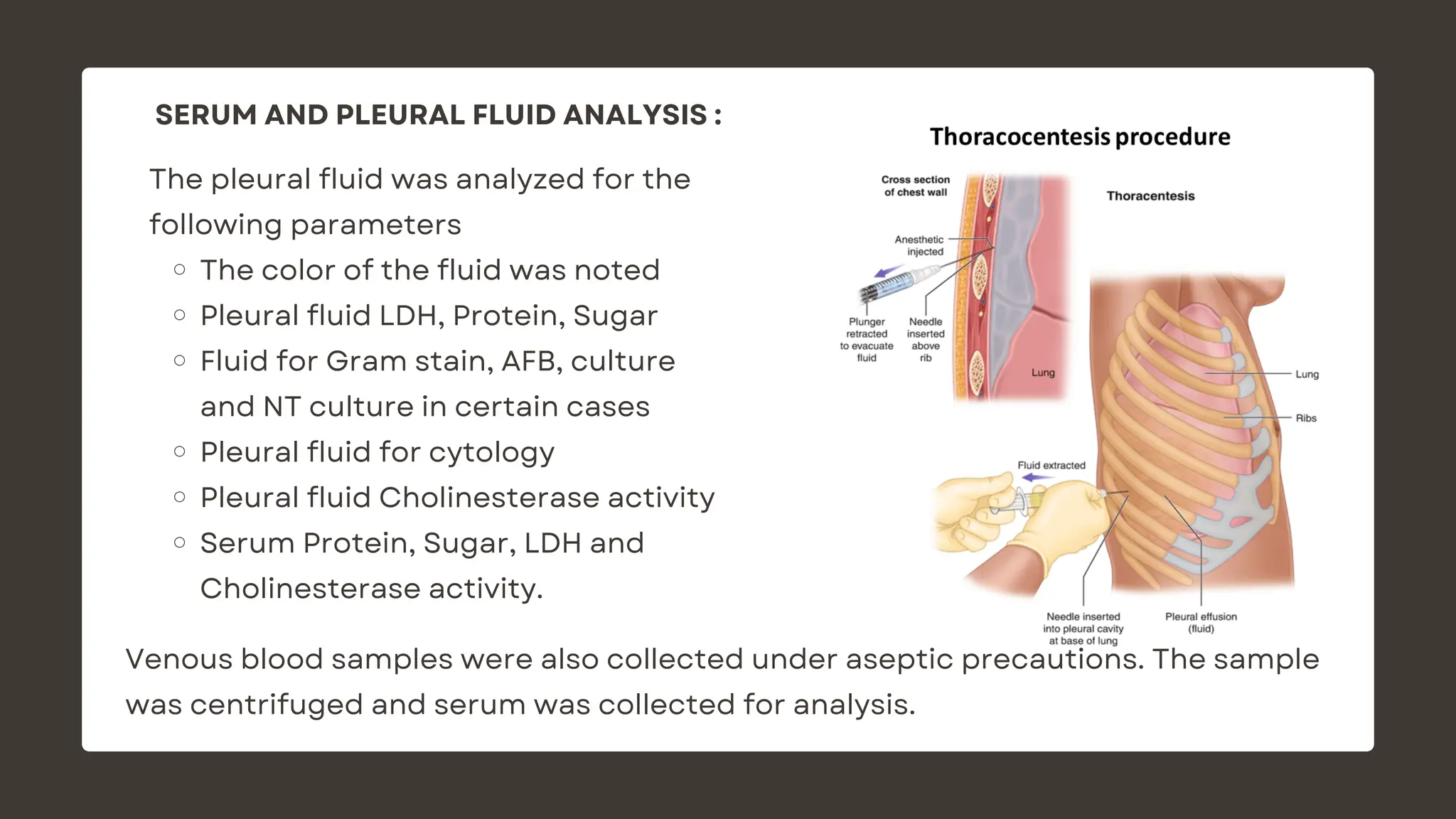 A study of serum to pleural effusion albumin gradient in ...