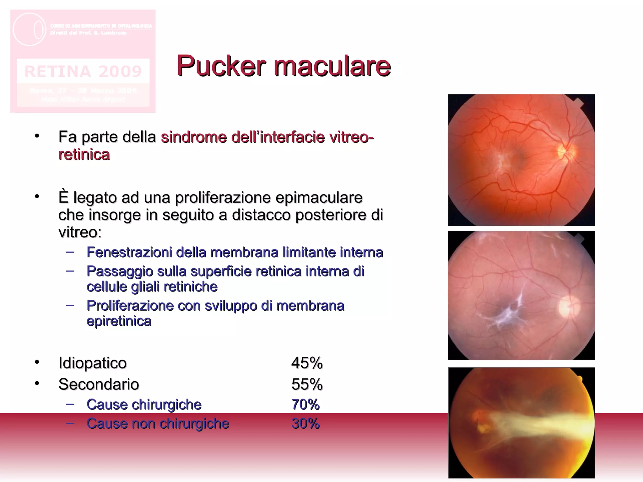 Pucker maculare | PPT
