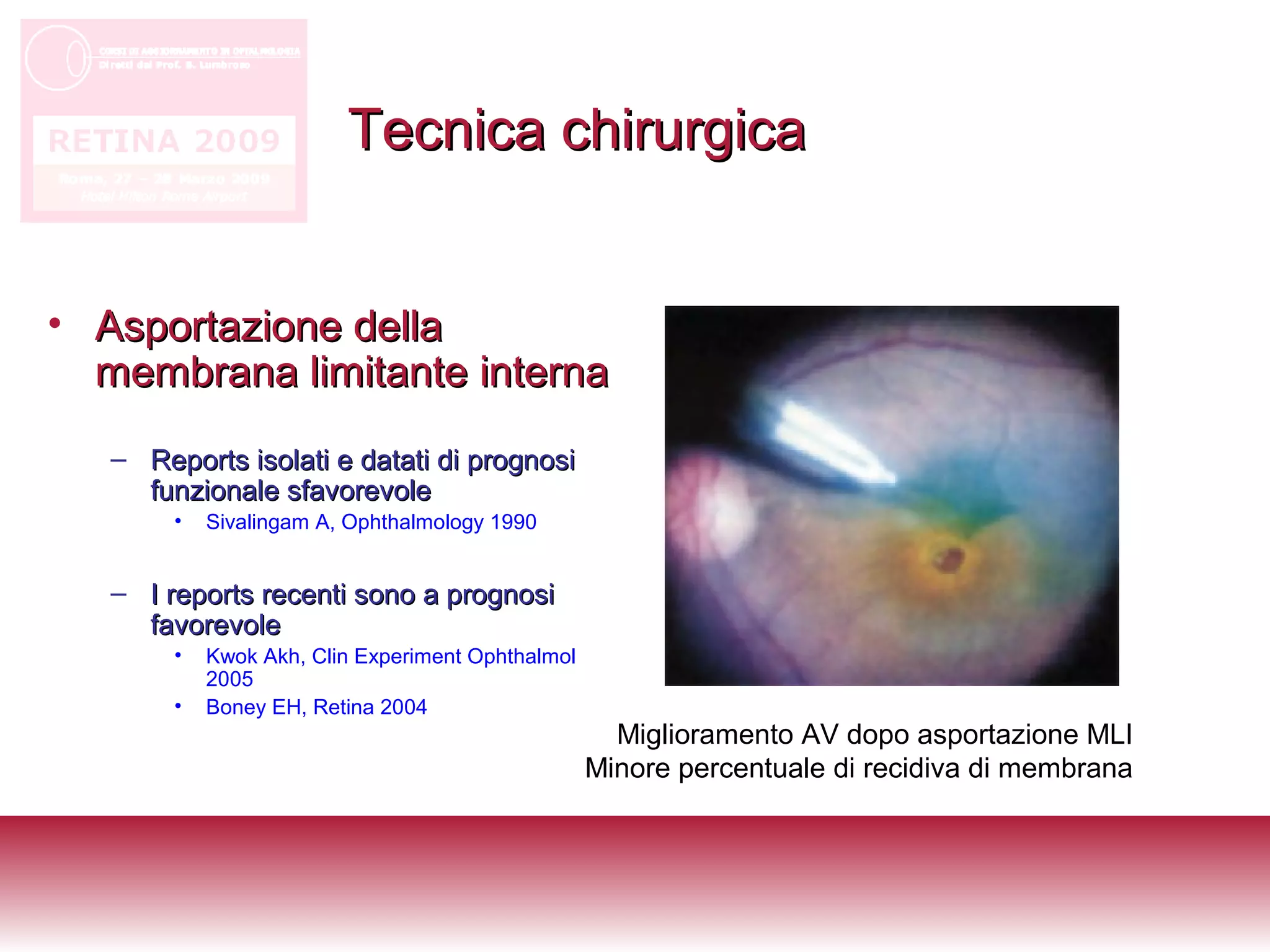 Pucker maculare | PPT