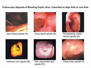 Peptic Ulcer Disease | PPT