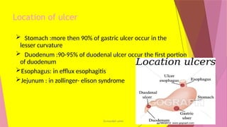 Approach to diagnosis and treatment PUD.pptx