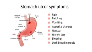 Peptic Ulcer Desease (PUD), Sores in the gastrium | PPTX