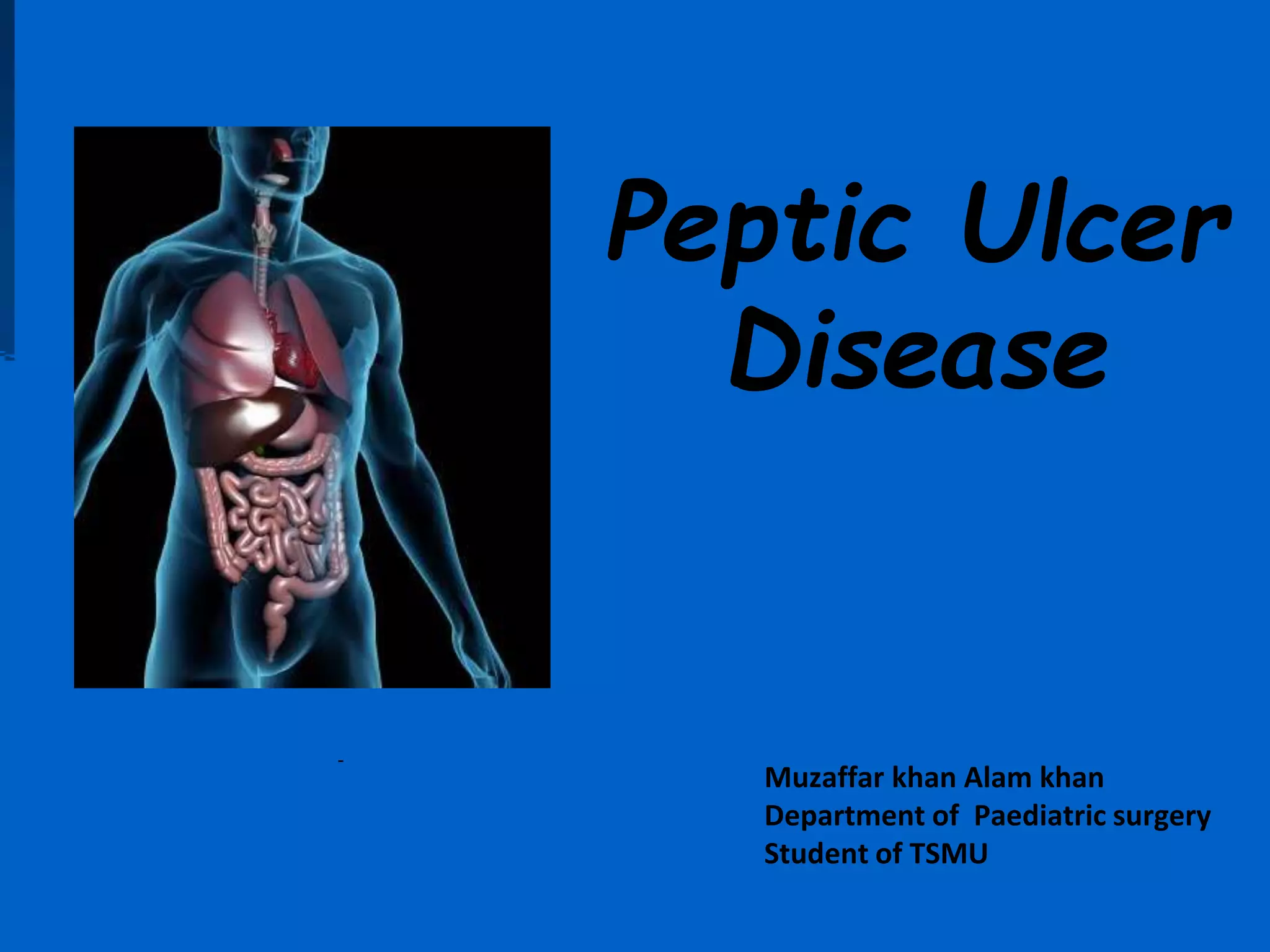 Peptic ulcer disease-child surgery | PPTX