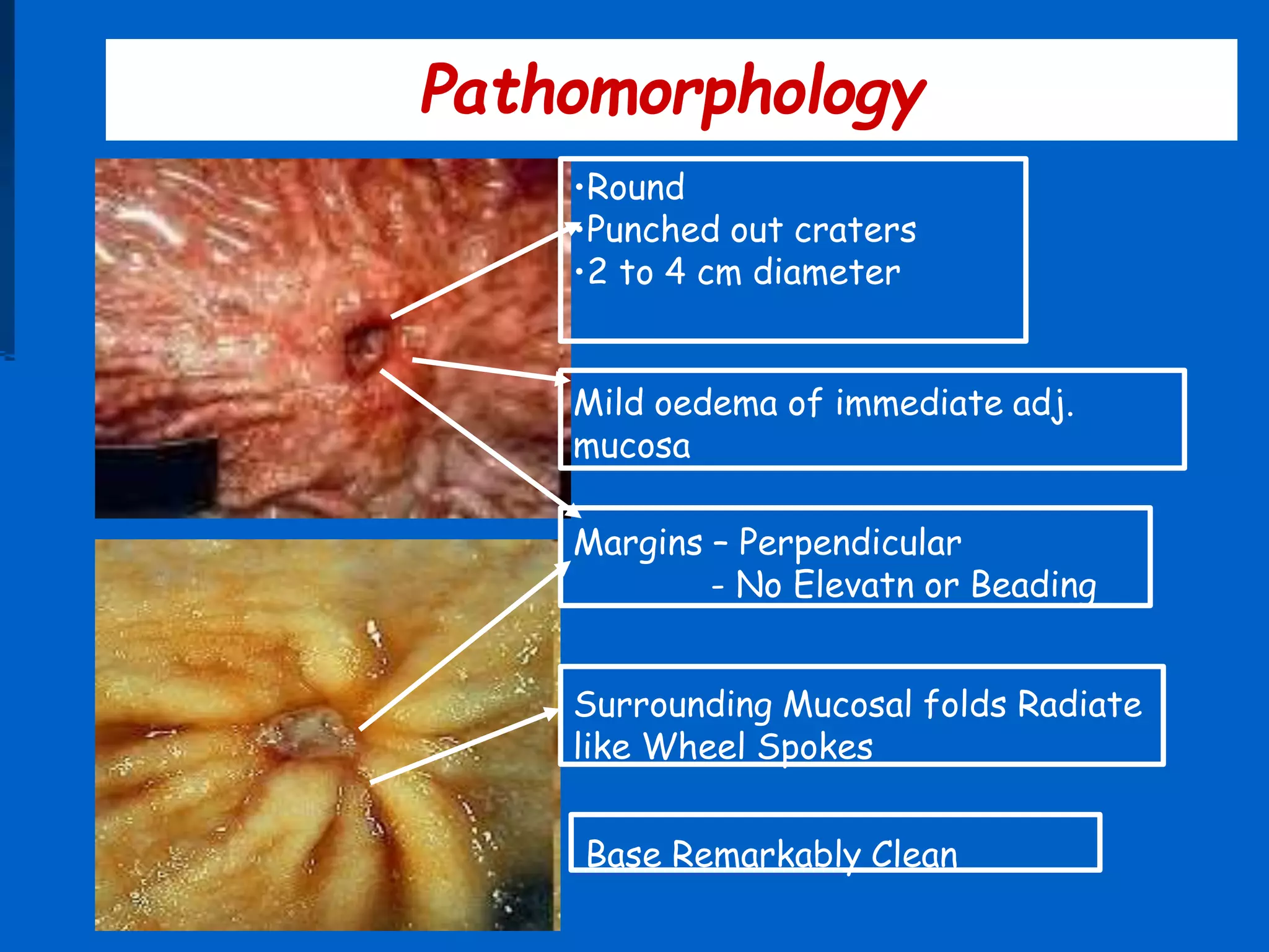 Peptic ulcer disease-child surgery | PPTX