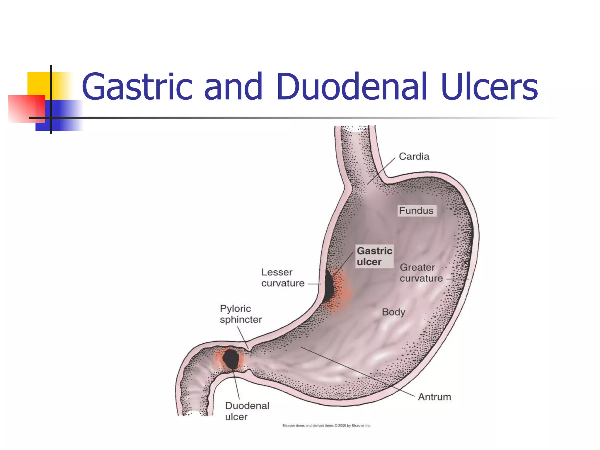 Peptic ulcer disease | PPT