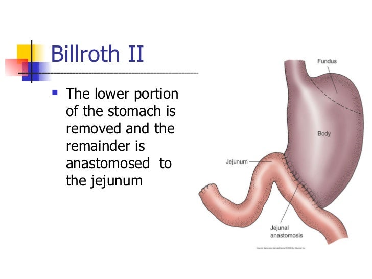 Billroth 2 Anatomy