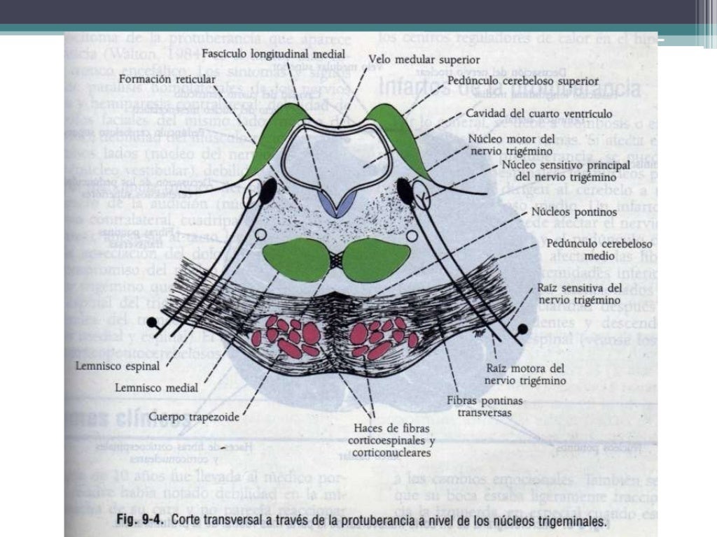 Puente o protuberancia
