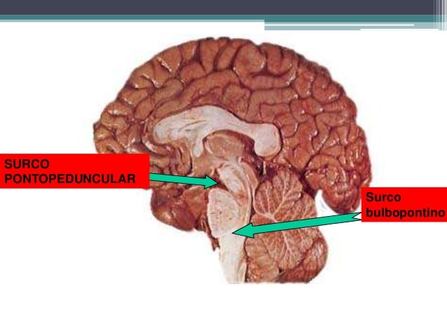 Puente o protuberancia