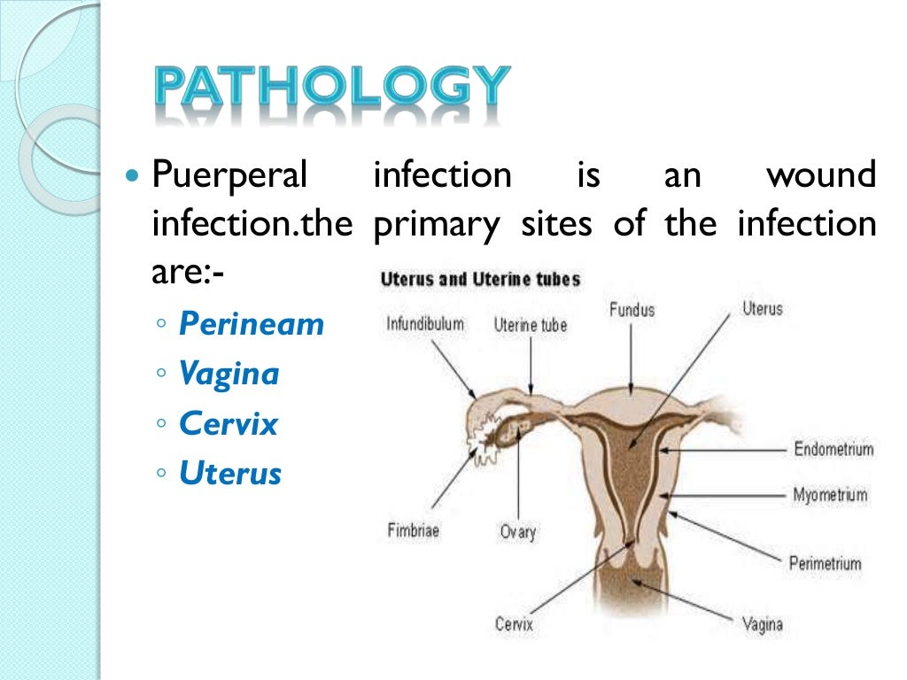 Puerperal sepsis