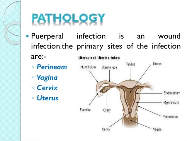 Puerperal sepsis