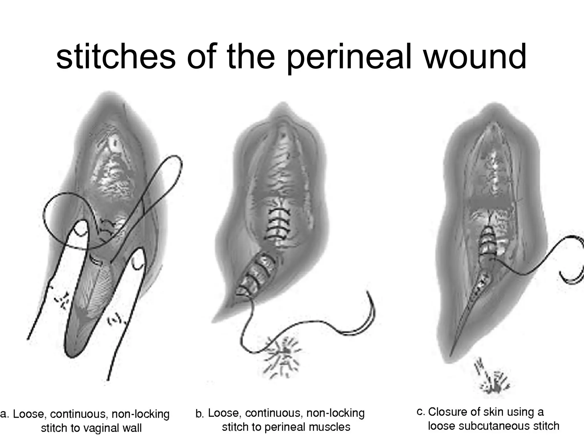 Puerperal sepsis | PPT