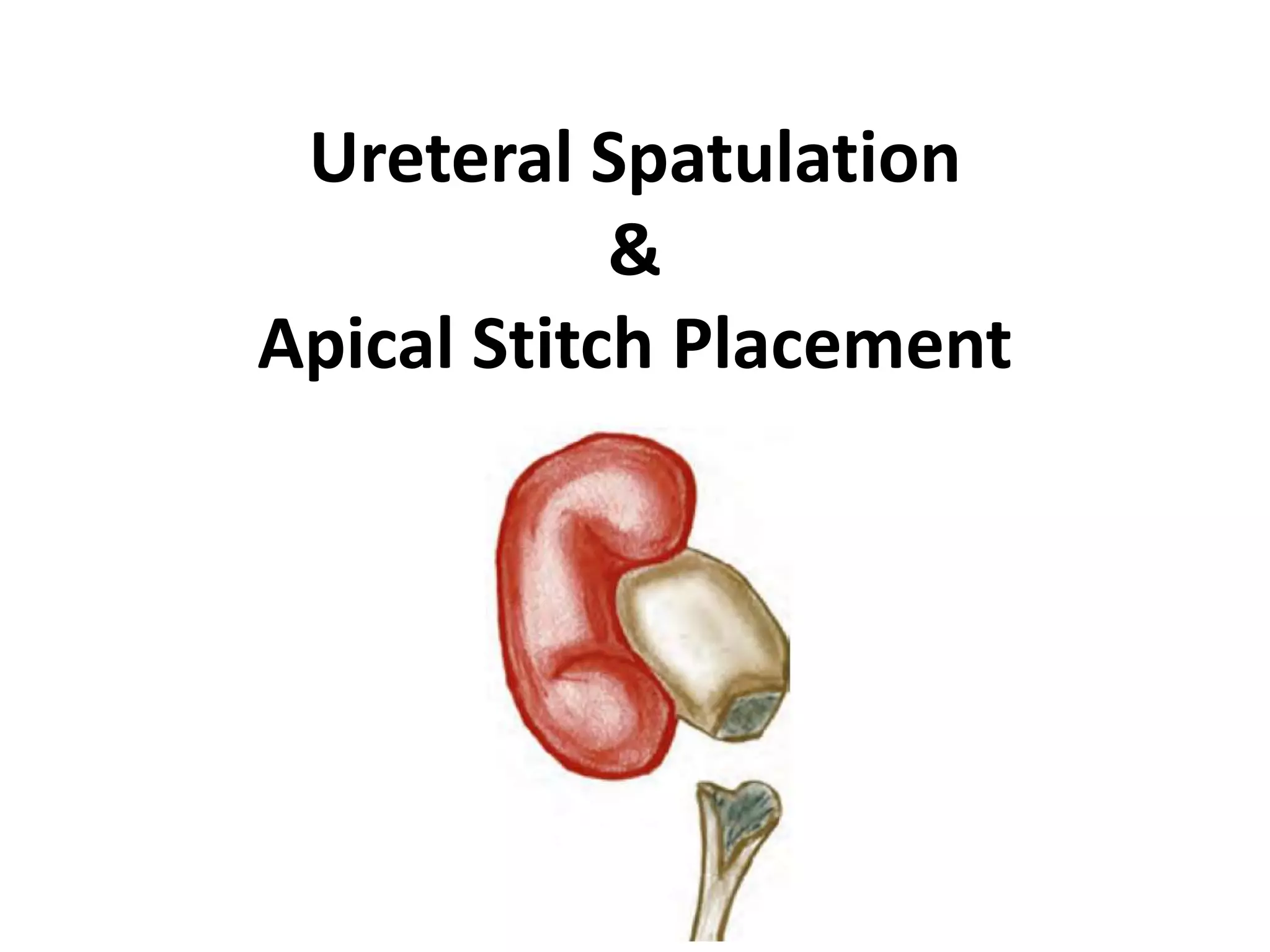 Pelviureteral Junction Obstruction (PUJO) - Laparoscopic and robotic ...