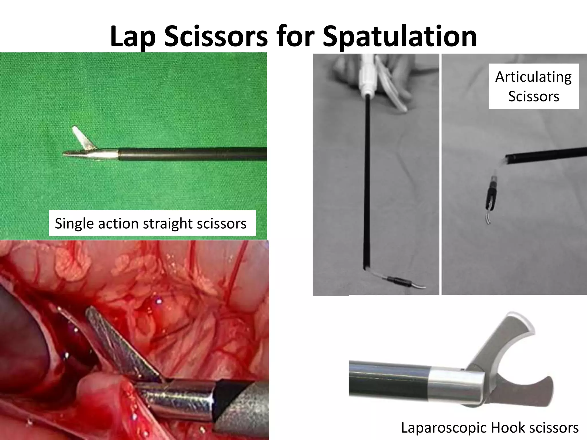 Pelviureteral Junction Obstruction (PUJO) - Laparoscopic and robotic ...